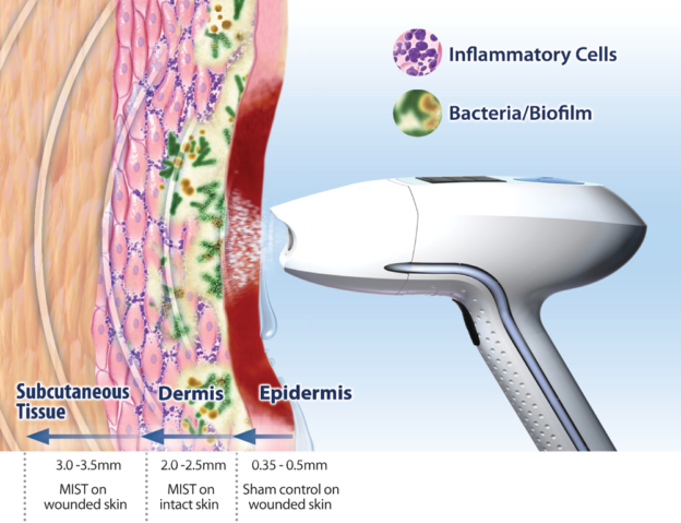 5 Reasons To Try Mist Therapy Today - Kaerbears Healthcare